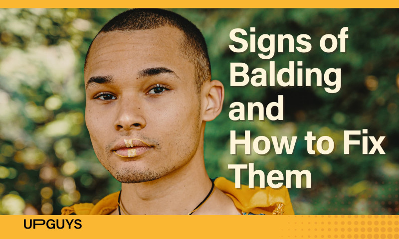 What are the early signs of baldness and how to stop them | UPGUYS